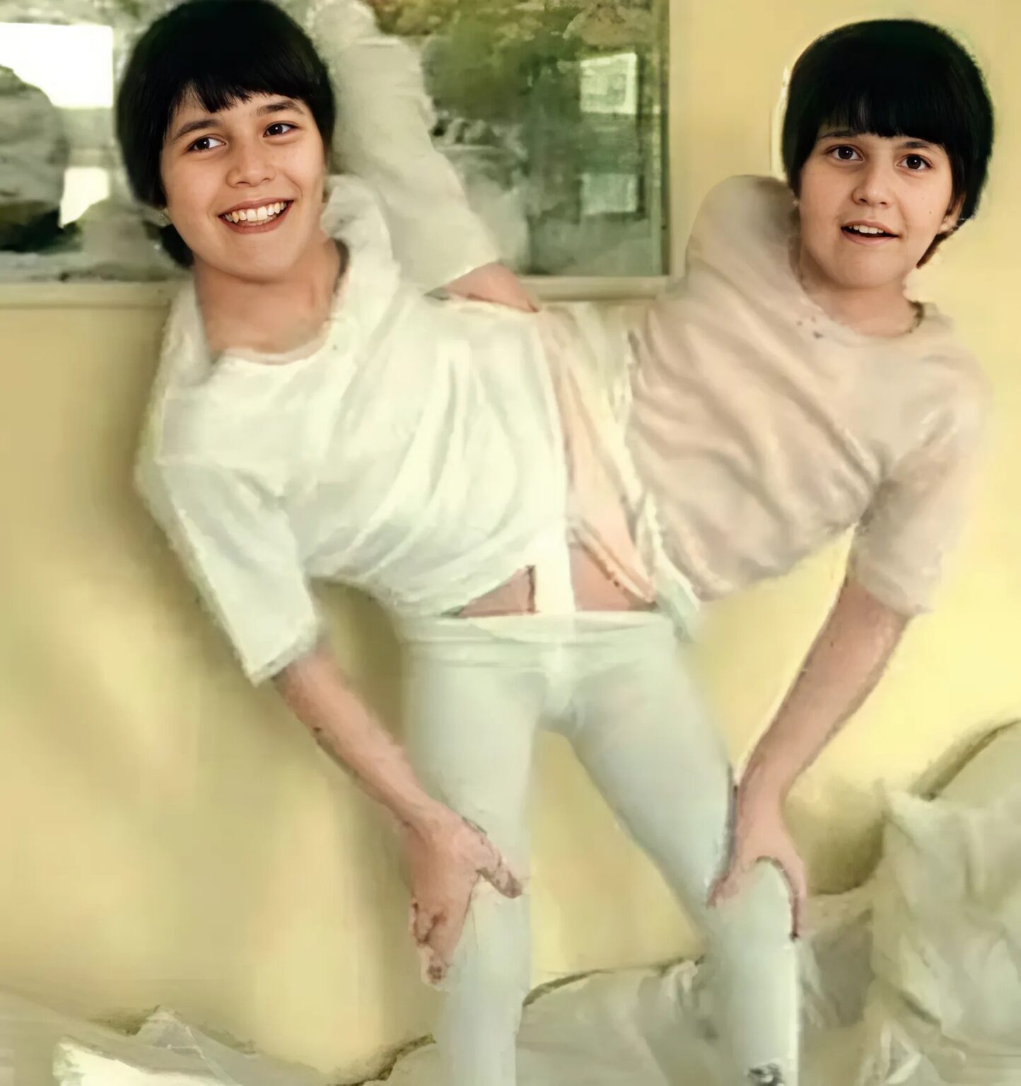 These sisters were conjoined twins born fused at the pelvic area They ...